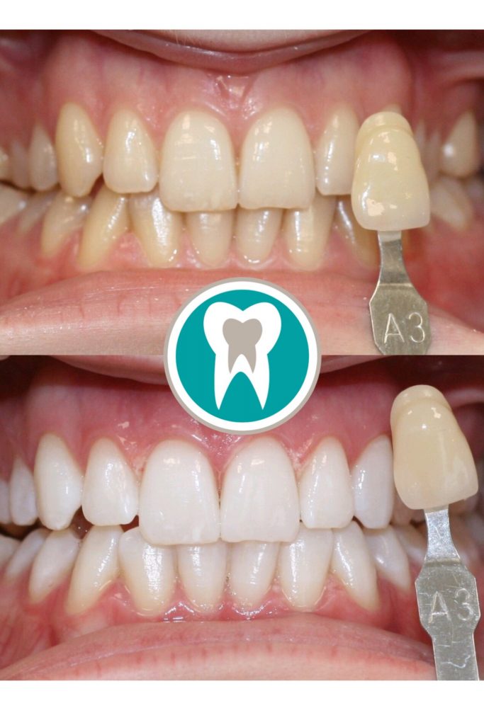Whiten and Brighten Your Teeth - Horfield Dental Care